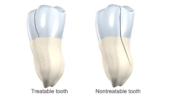 Cracked Teeth | Scripps Mesa Endodontics