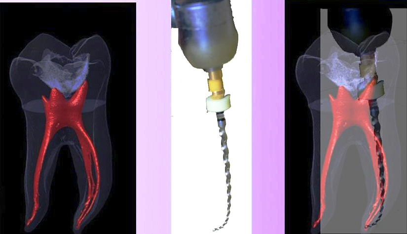 Root Canal Therapy | Scripps Mesa Endodontics